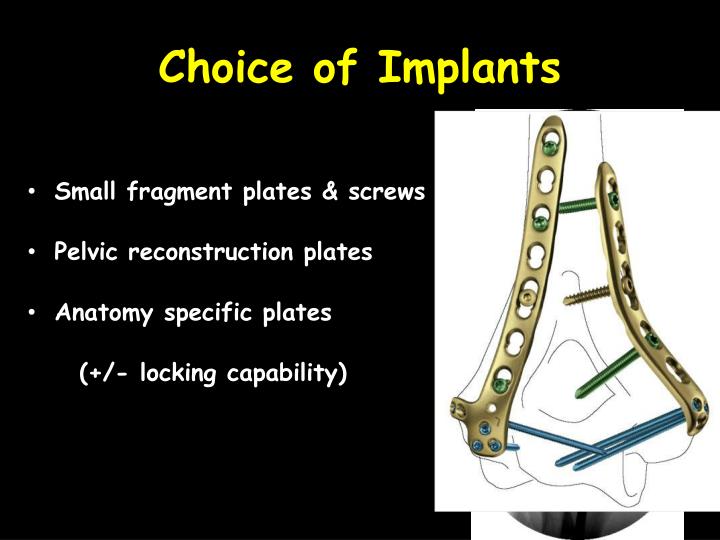 PPT - Surgical Management of Intra-Articular Distal Humerus Fractures ...