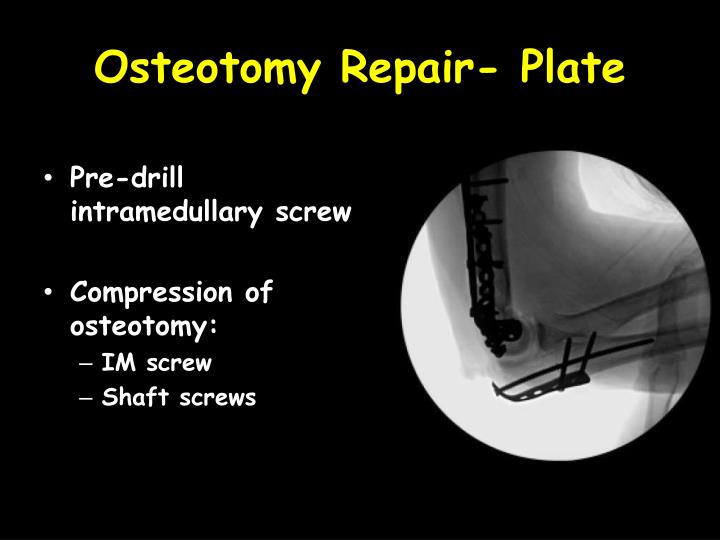 PPT - Surgical Management of Intra-Articular Distal Humerus Fractures ...