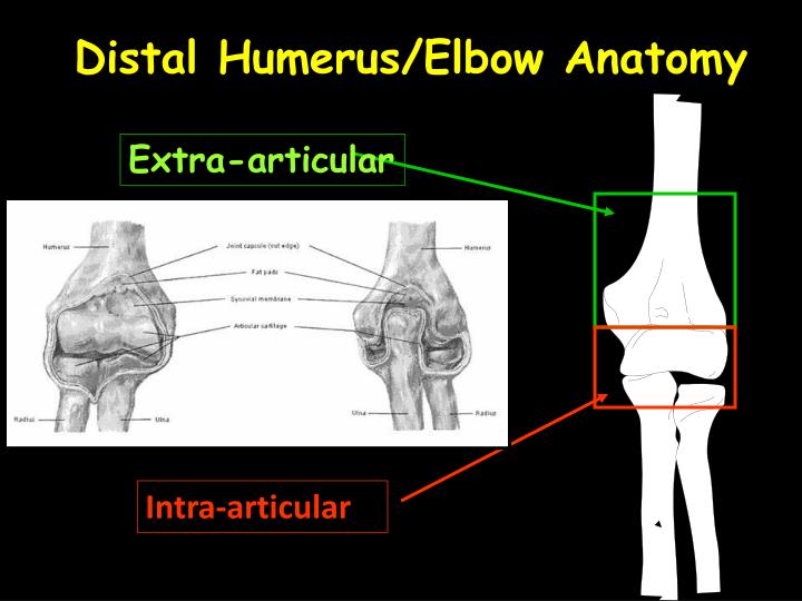 PPT - Surgical Management of Intra-Articular Distal Humerus Fractures ...