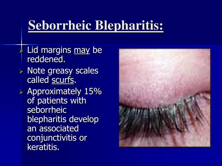 Seborrheic Blepharitis Treatment