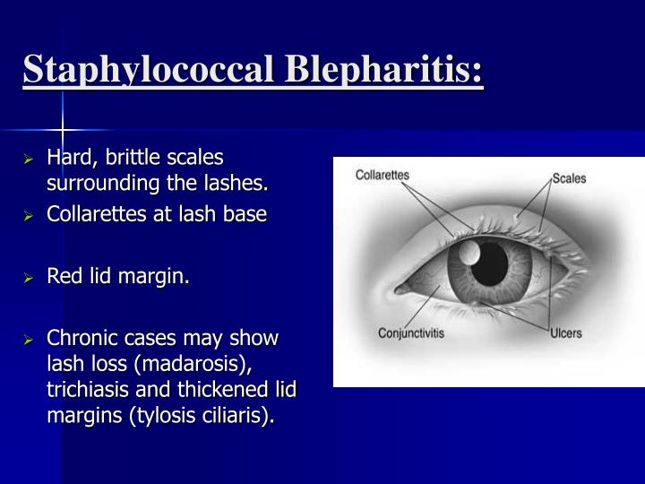 PPT - Lid Infections & Management PowerPoint Presentation - ID:5640537