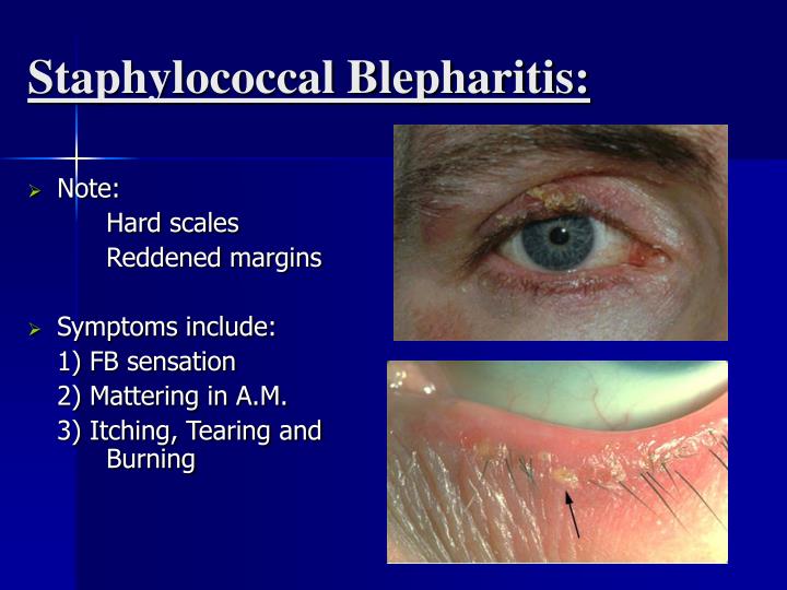 PPT - Lid Infections & Management PowerPoint Presentation - ID:5640537