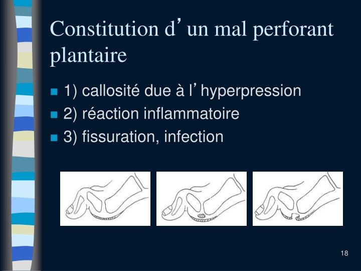 PPT - Le pied diabétique PowerPoint Presentation - ID:5645006