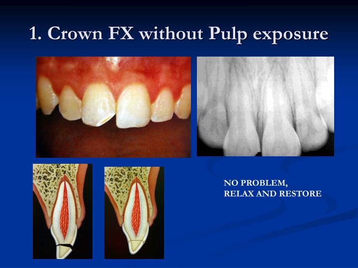 PPT - Traumatic Injuries, Cracked Teeth and vertical root fractures ...