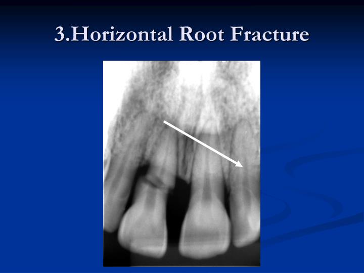 PPT - Traumatic Injuries, Cracked Teeth and vertical root fractures ...