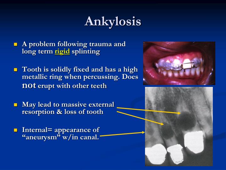 PPT - Traumatic Injuries, Cracked Teeth and vertical root fractures ...