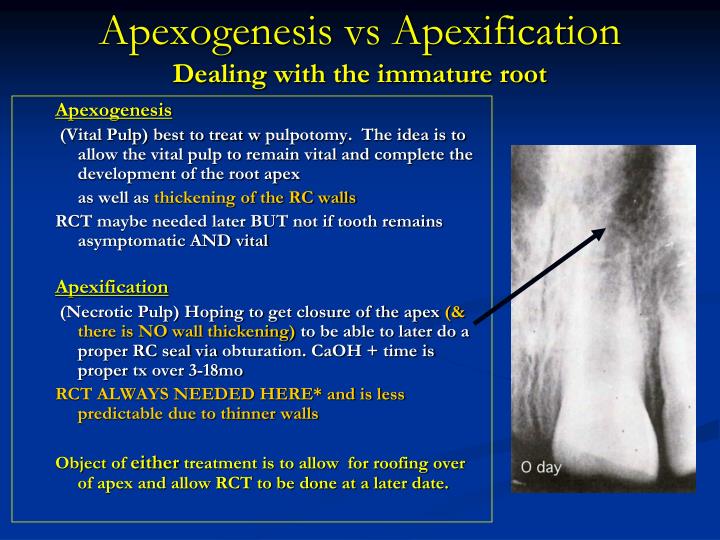 PPT - Traumatic Injuries, Cracked Teeth and vertical root fractures ...