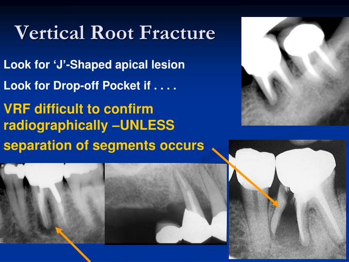 PPT - Traumatic Injuries, Cracked Teeth and vertical root fractures ...