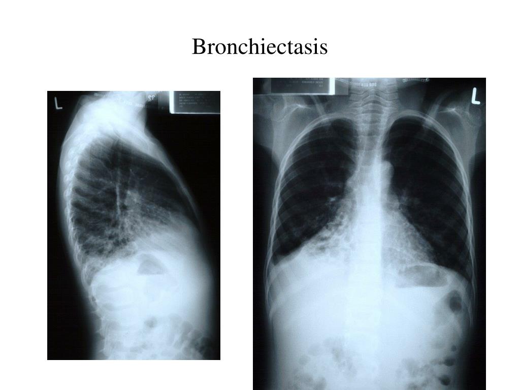 PPT - Chronic Lung Disease in Children PowerPoint Presentation, free ...