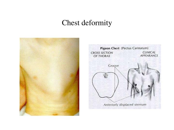 PPT - Chronic Lung Disease in Children PowerPoint Presentation - ID:5650808