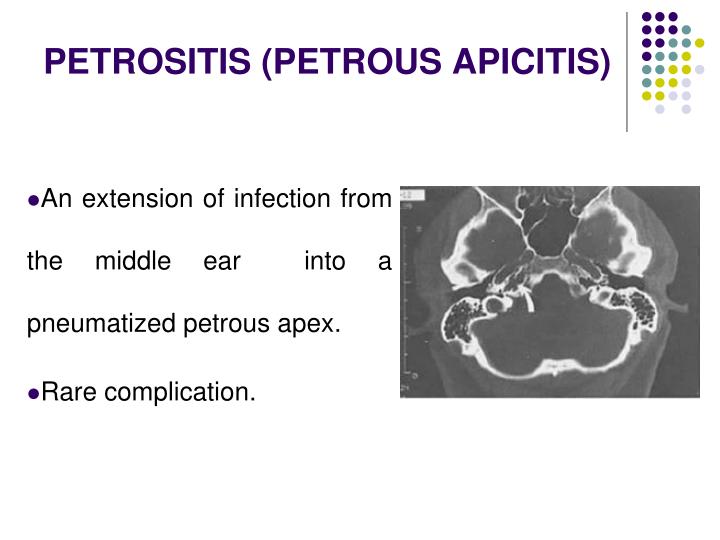 PPT - Ear IV: COMPLICATIONS OF SUPPURATIVE OTITIS MEDIA PowerPoint ...
