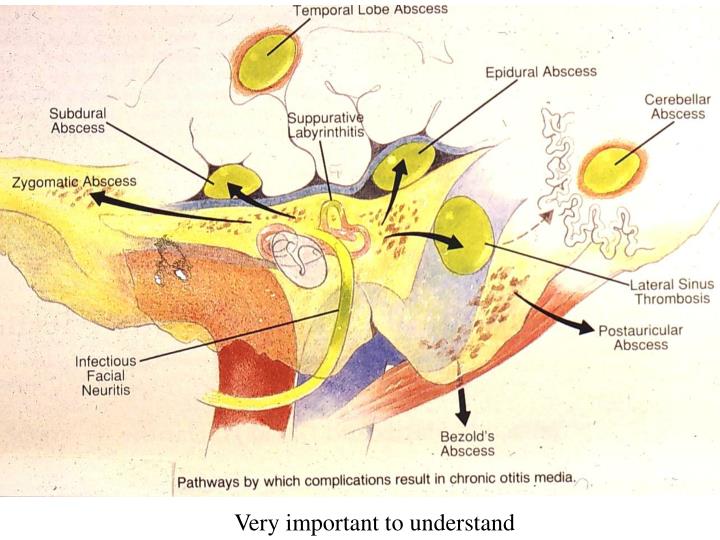 PPT - Ear IV: COMPLICATIONS OF SUPPURATIVE OTITIS MEDIA PowerPoint ...