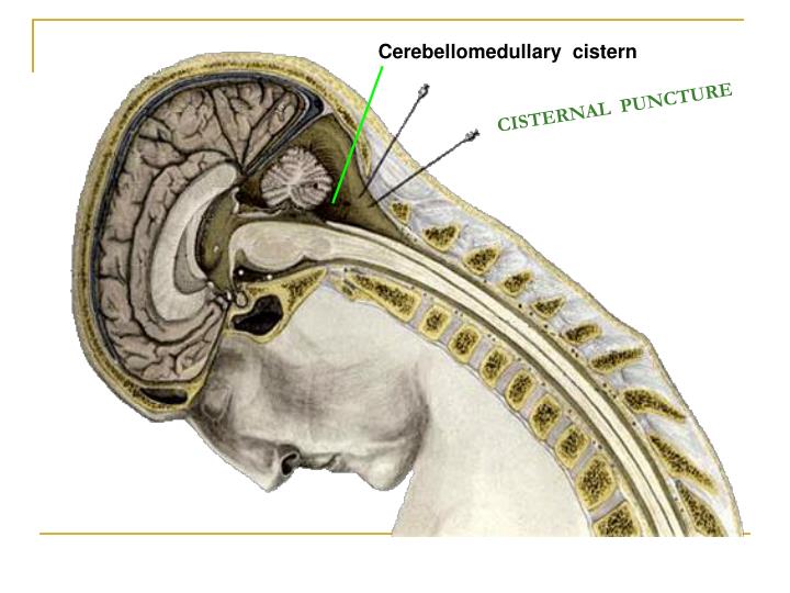 PPT - The Meninges of Brain and Spinal Cord PowerPoint Presentation ...