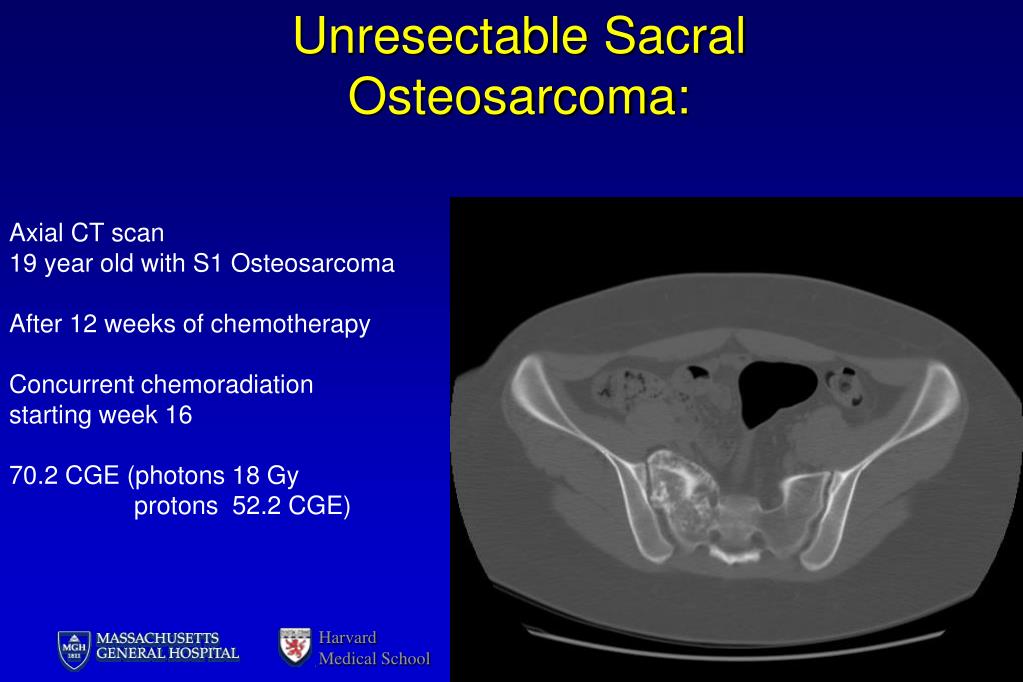 PPT - Phase II Study of Proton Radiation Therapy for Spine and ...