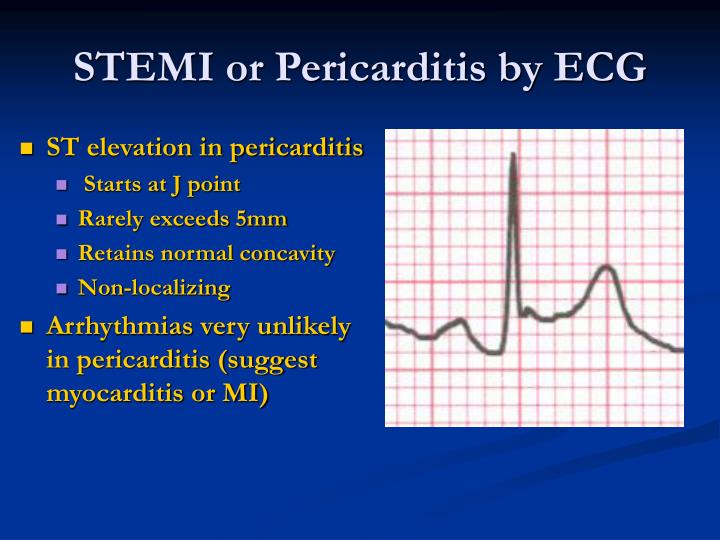 PPT - Acute Pericarditis and Pericardial Effusion PowerPoint ...