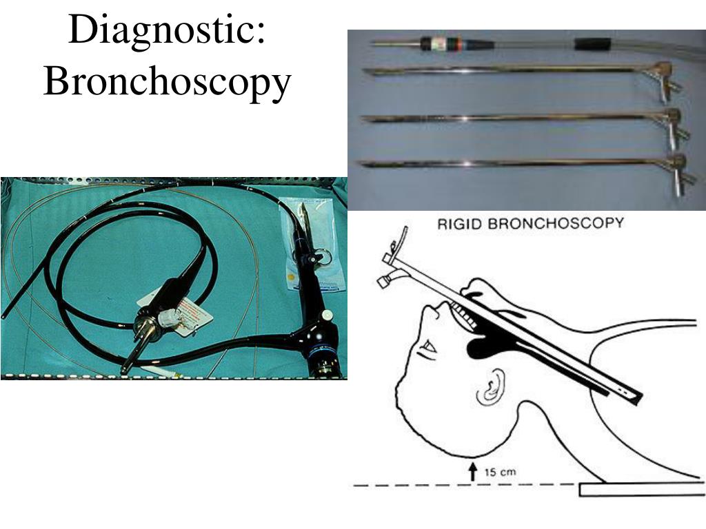 PPT - Surgical Management of Lung Cancer PowerPoint Presentation, free ...