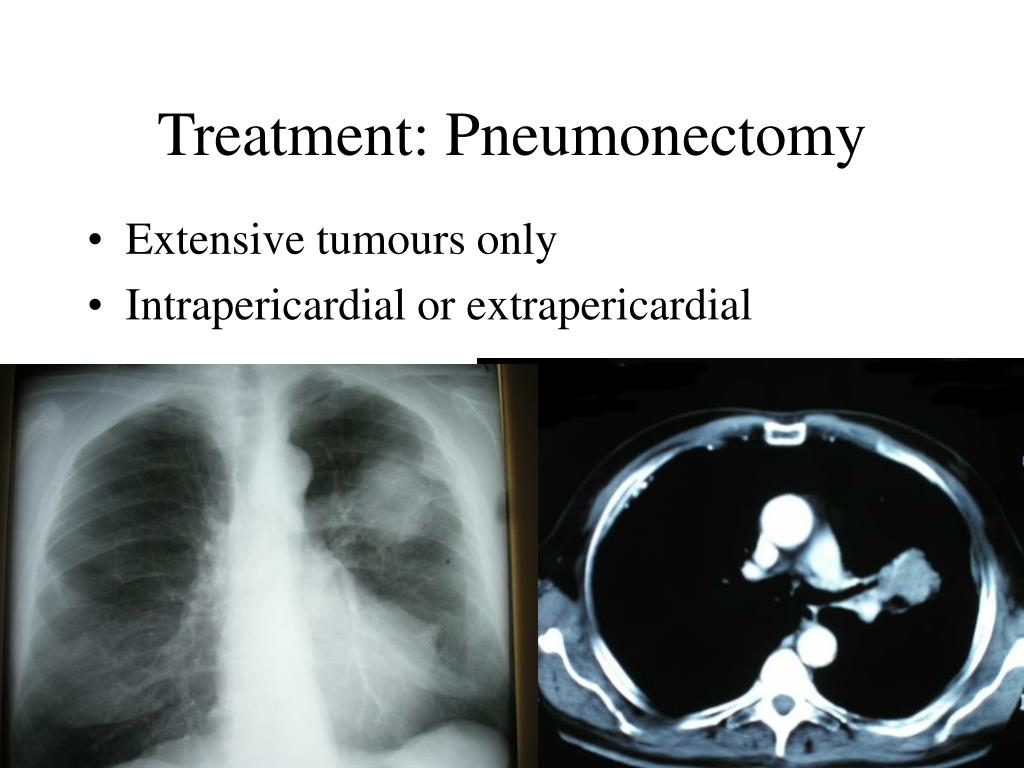 PPT - Surgical Management of Lung Cancer PowerPoint Presentation, free ...