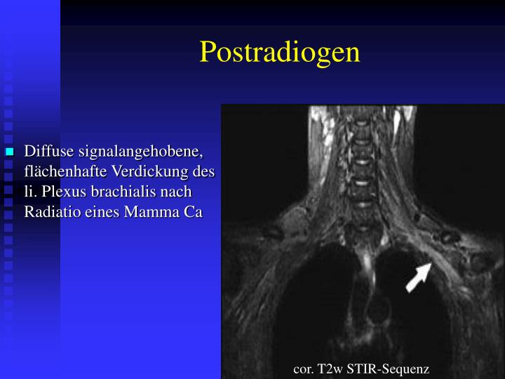 PPT - MRT bei Plexus brachialis Läsionen PowerPoint Presentation - ID ...