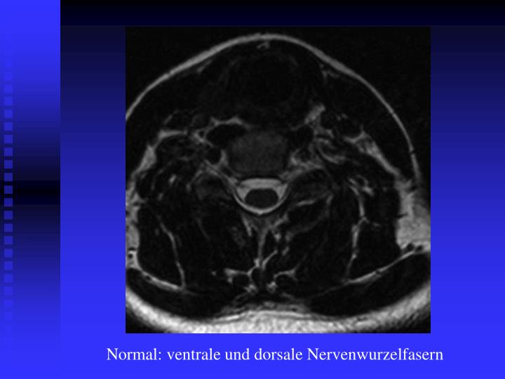 PPT - MRT bei Plexus brachialis Läsionen PowerPoint Presentation - ID ...