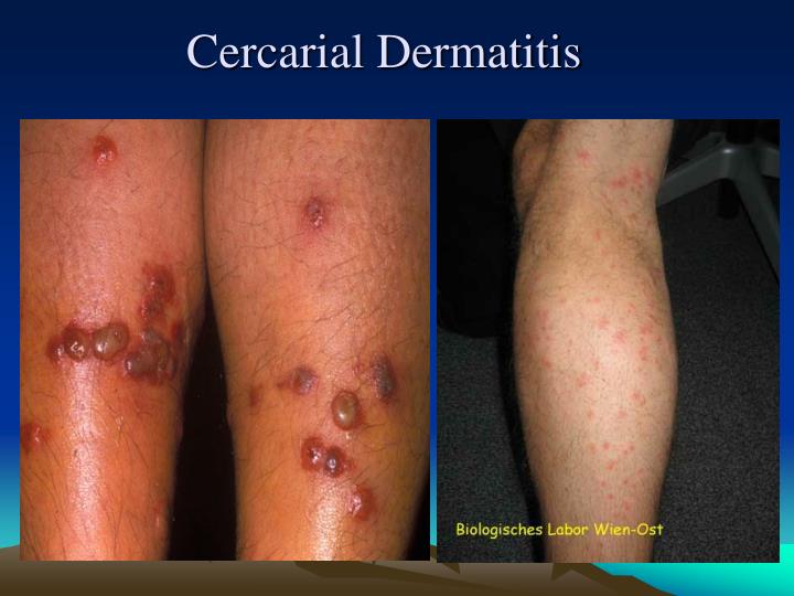 PPT - Schistosoma PowerPoint Presentation - ID:5658490