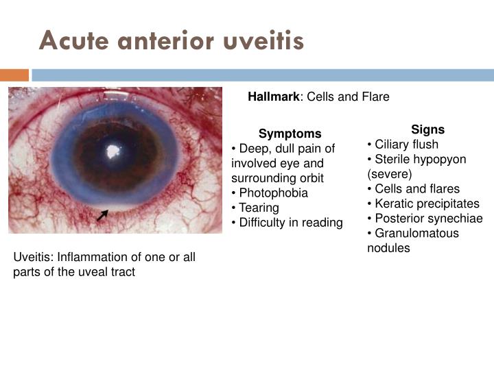 Uveitis Causes Symptoms And Treatment