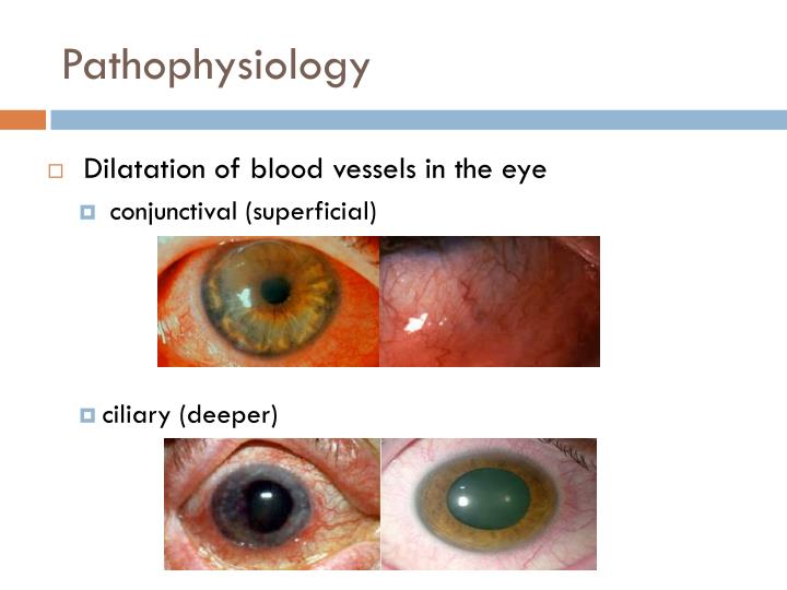 PPT - Red Eye PowerPoint Presentation - ID:5658491