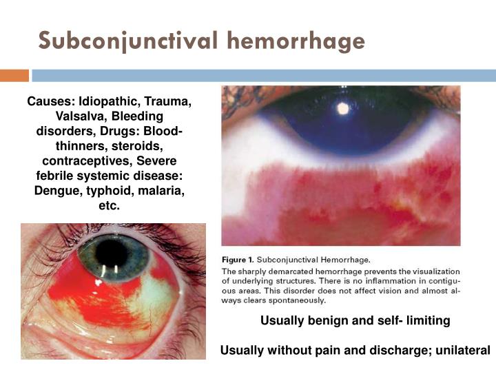 Blood In Eye Subconjunctival Hemorrhage Causes And Tr - vrogue.co