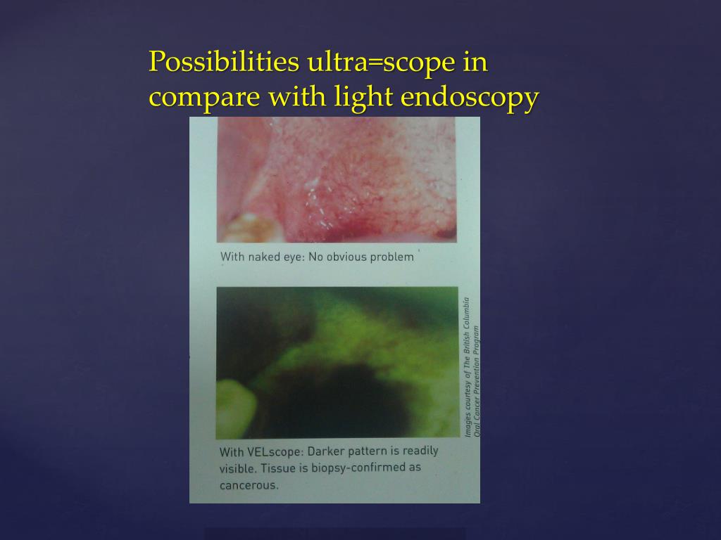 PPT - Oral Cancer Early diagnostic and Treatment PowerPoint ...