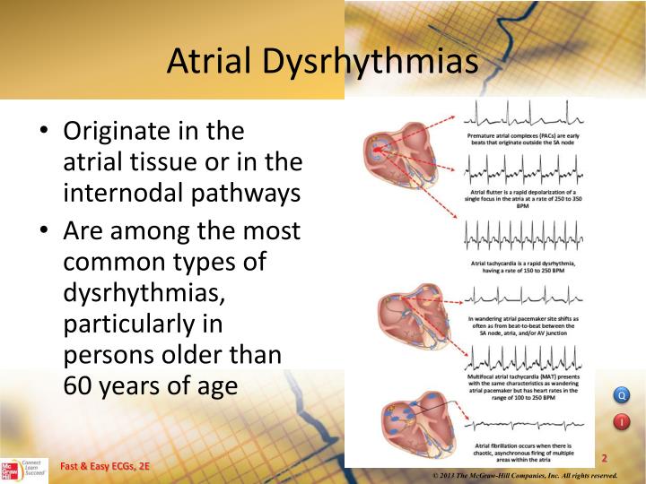 PPT - Atrial Dysrhythmias PowerPoint Presentation - ID:5660215