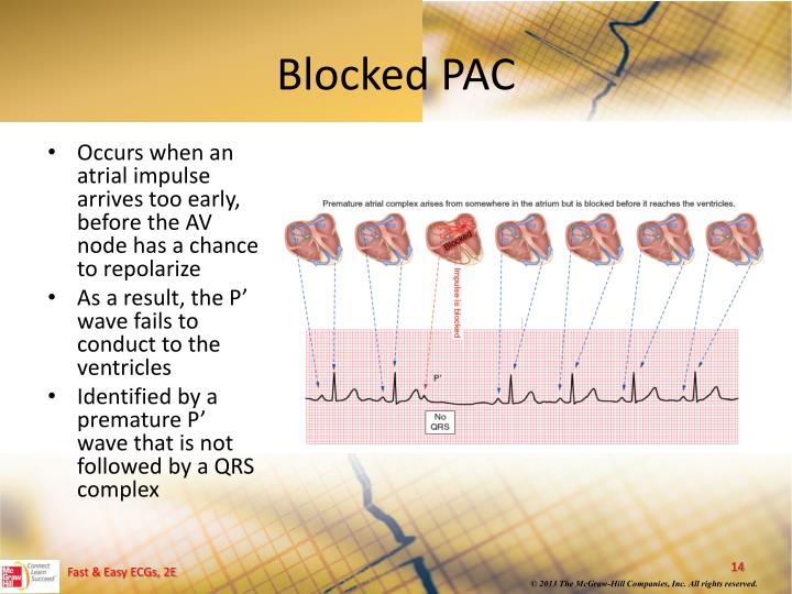 PPT - Atrial Dysrhythmias PowerPoint Presentation - ID:5660215