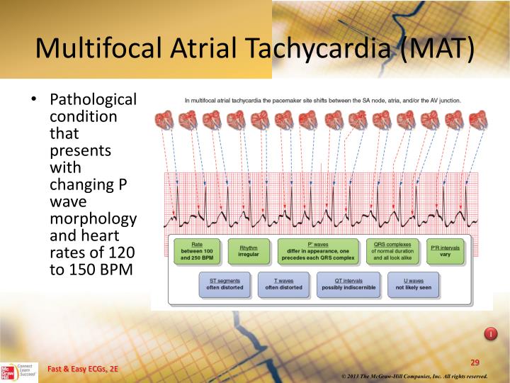 PPT - Atrial Dysrhythmias PowerPoint Presentation - ID:5660215