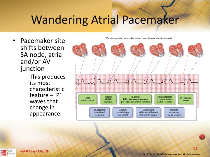 PPT - Atrial Dysrhythmias PowerPoint Presentation - ID:5660215