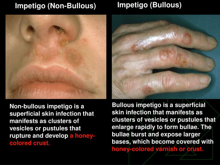 PPT - Bacterial Skin Infections PowerPoint Presentation - ID:5660934