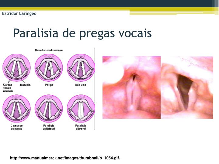PPT - Estridor laríngeo PowerPoint Presentation - ID:5662444