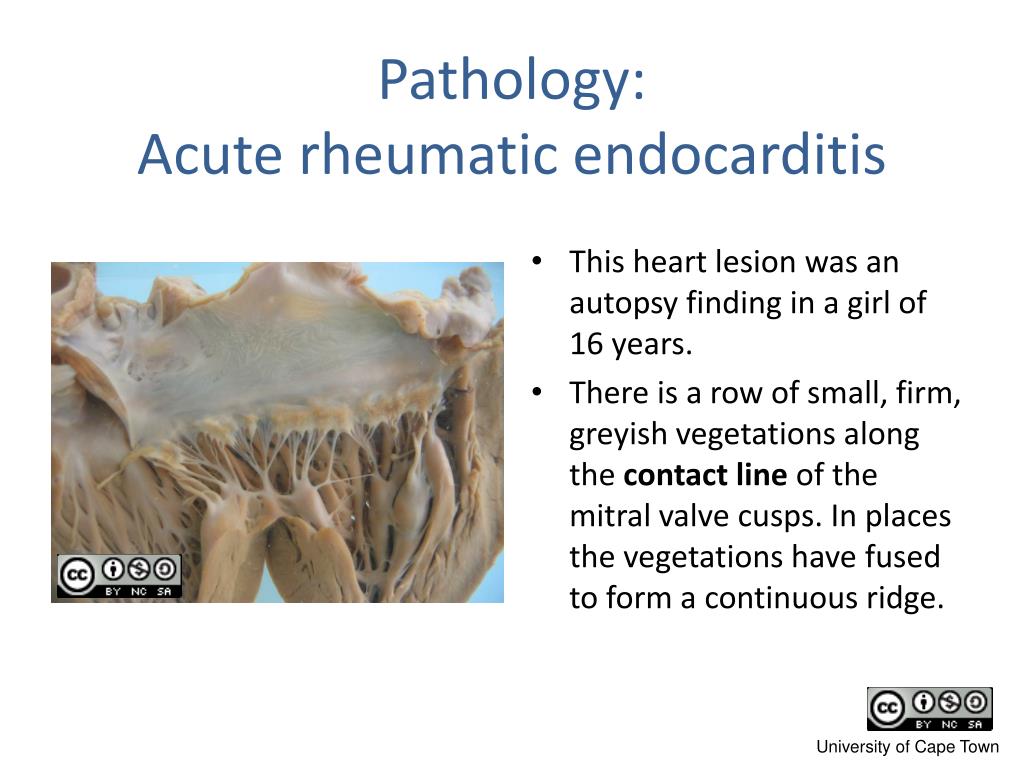 PPT - Rheumatic heart disease PowerPoint Presentation, free download ... PPT - Rheumatic heart disease PowerPoint Presentation, free download ...