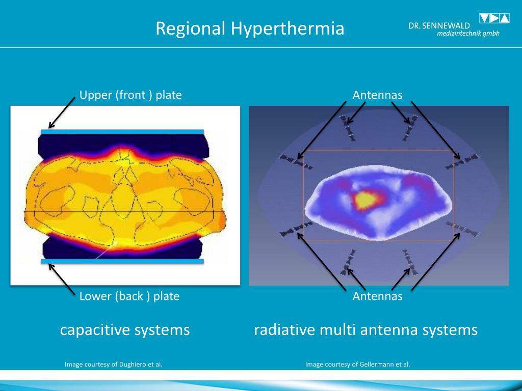 PPT - MR Image Guided Hyperthermia Gerhard Sennewald PhD, Munich ...