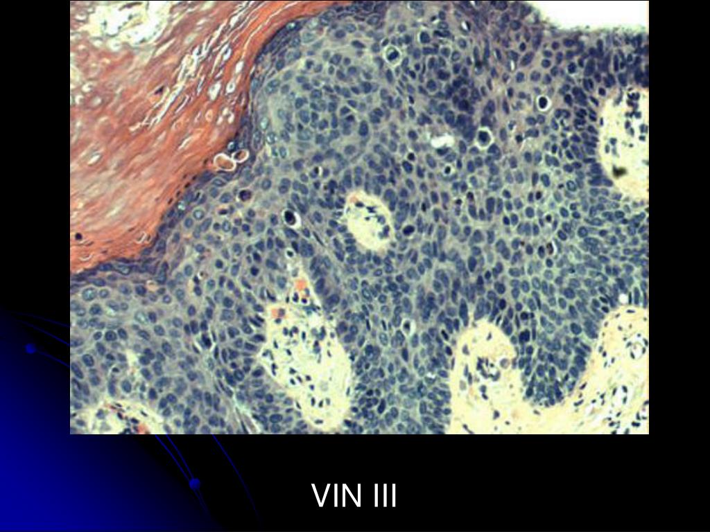 PPT - Pre-cancer and malignant disease of vulva PowerPoint Presentation ...