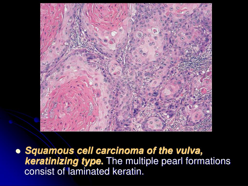 PPT - Pre-cancer and malignant disease of vulva PowerPoint Presentation ...