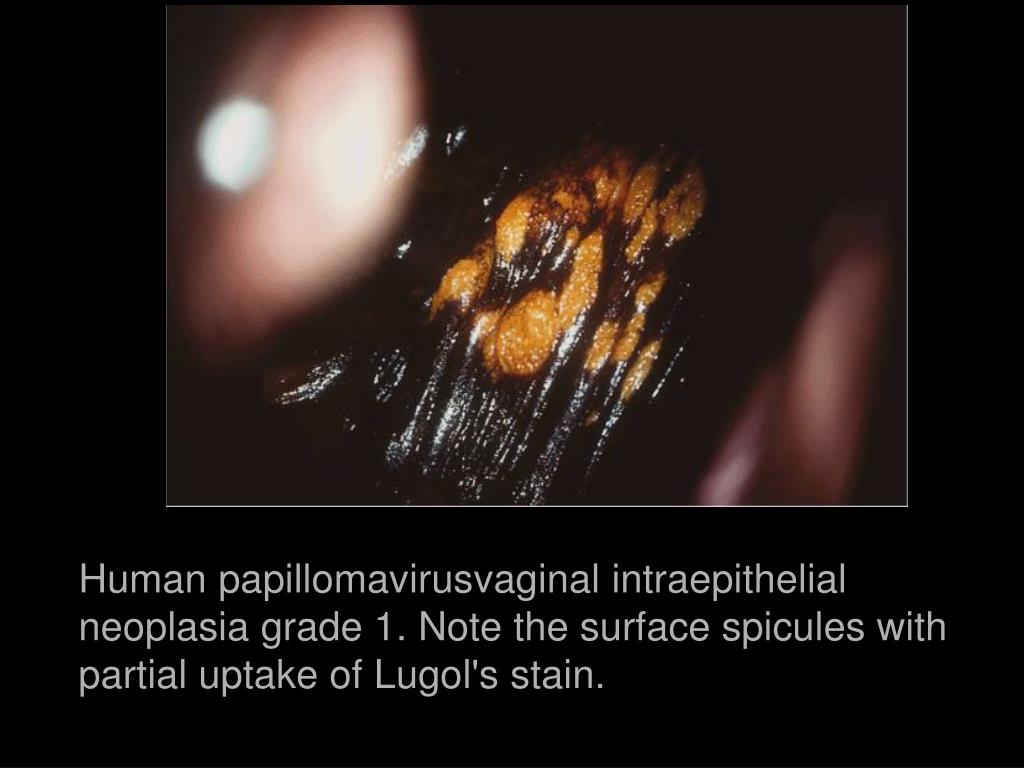 PPT - Pre-cancer and malignant disease of vulva PowerPoint Presentation ...