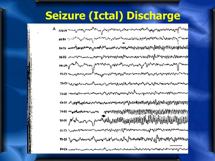 PPT - Neuropsychology of Epilepsy PowerPoint Presentation - ID:5668743