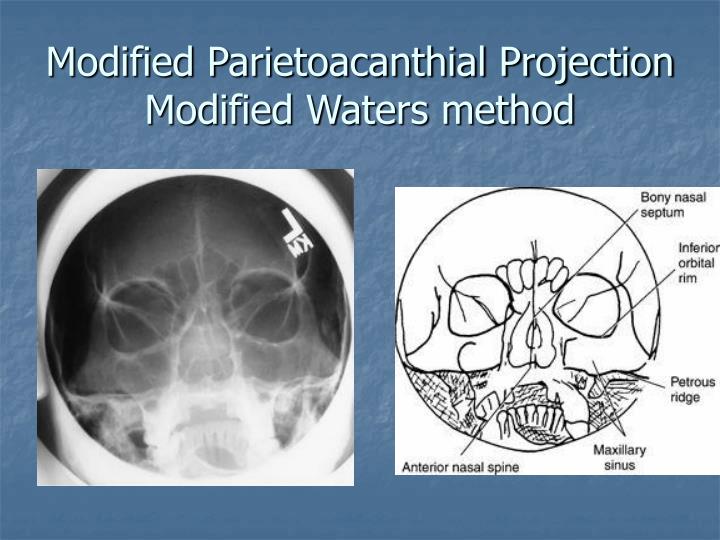 PPT - Radiography of the Orbits PowerPoint Presentation - ID:5669687
