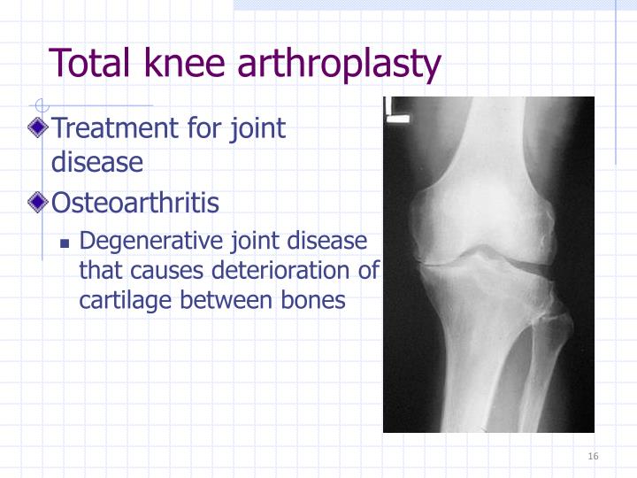 PPT - TOTAL KNEE ARTHROPLASTY (TKA) Total Knee Replacement (TKR ...