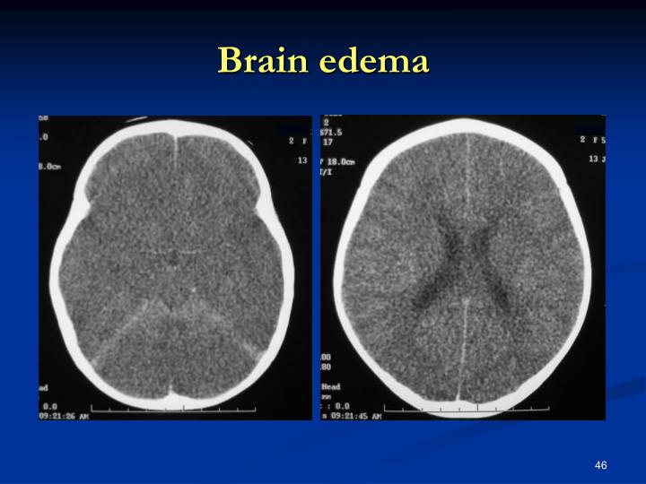 PPT - Radiology of common brain diseases PowerPoint Presentation - ID ...