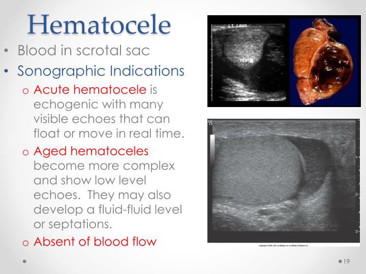 PPT - Scrotal Ultrasound PowerPoint Presentation - ID:5671926