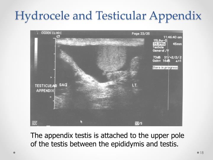 Apendice Testicular