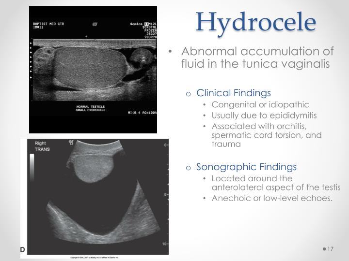 PPT - Scrotal Ultrasound PowerPoint Presentation - ID:5671926