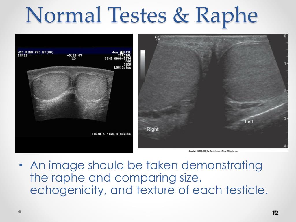 Ppt Scrotal Ultrasound Powerpoint Presentation Free Download Id
