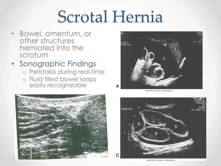 PPT - Scrotal Ultrasound PowerPoint Presentation - ID:5671926
