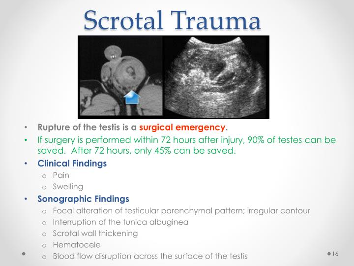 PPT - Scrotal Ultrasound PowerPoint Presentation - ID:5671926