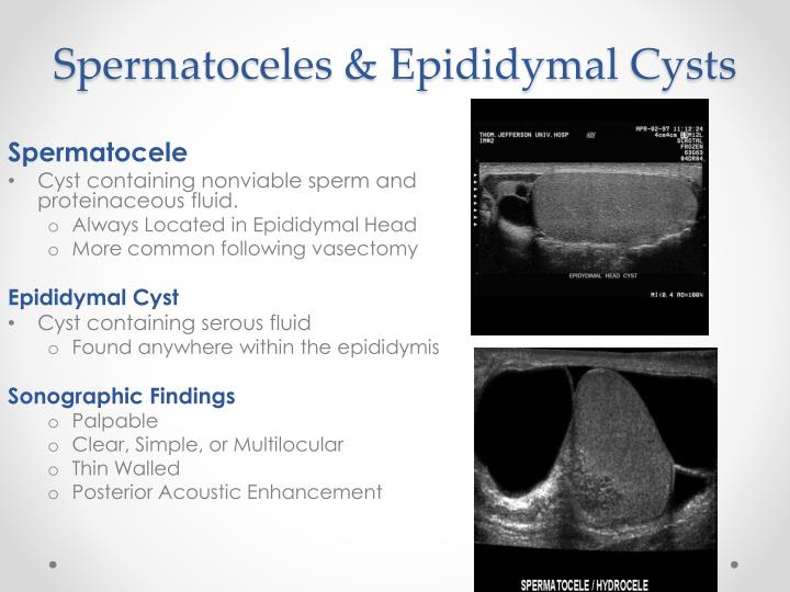 Spermatocele Testicular Cysts